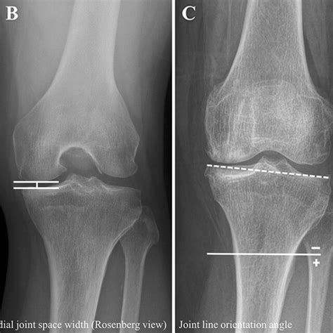 Schematic Measurement Of The Medial Joint Space Width Mjsw Joint