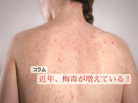 「梅毒患者急増！日本・米国で感染者数が増加中」 ワールドニュースラボ