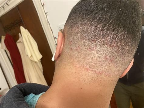 Scalp Psoriasis Help R Psoriasis