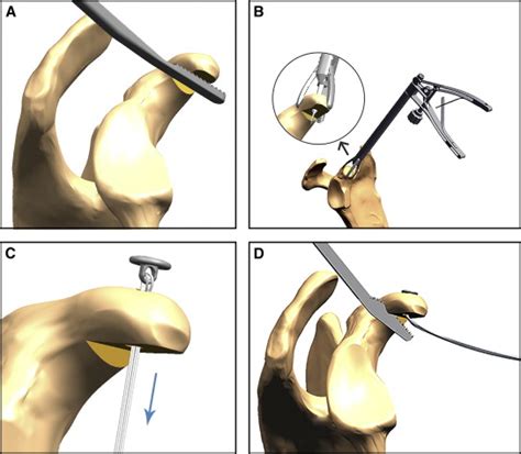 Coracoid Preparation Drilling And Osteotomy A The Coracoid Graft