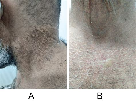 Pseudoxanthoma Elasticum