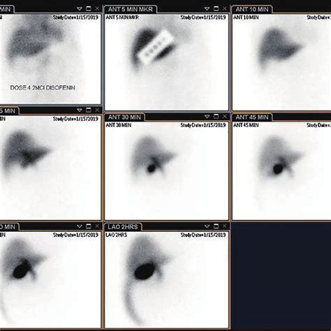 Ultrasound Imaging Of An Acalculous Hydropic Gallbladder With