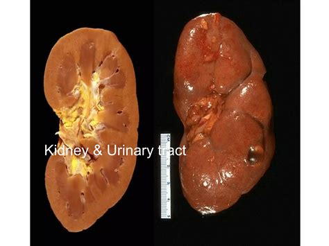 Urinary Tract Pathology Lab Pdf