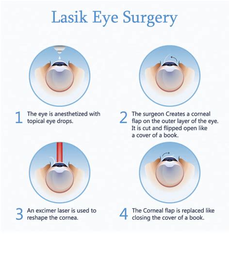 What Does Lasik Eye Surgery Feel Like Optilase Laser Eye Surgery
