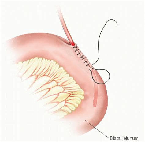 Jejunostomy Tube Basicmedical Key