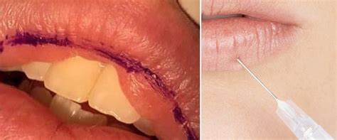 The Risks Of Lip Fillers What You Need To Know