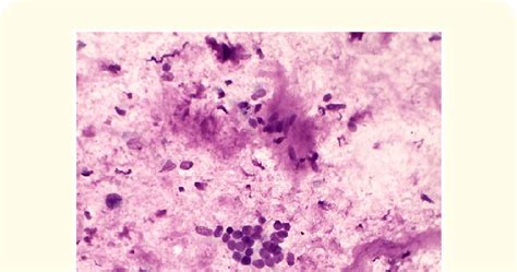 Smear Showing Bland Epithelial Cell Cluster Along With Myoepithelial