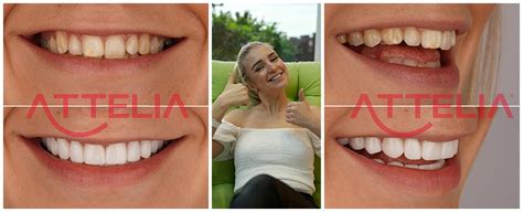 Emax Crowns In Turkey Attelia Dental Turkey Global Award Winning