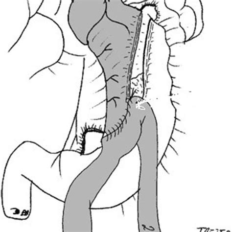 Omega Gastric Bypass After Nissen Download Scientific Diagram