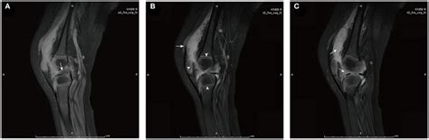 Mri Of The Right Knee Proton Density Weighted A And T2 Weighted B