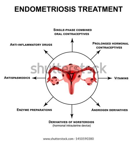 Treatment Endometriosis Adenomyosis Structure Pelvic Organs Stock
