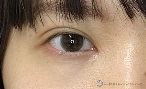 ヒアルロン酸（涙袋） Original Beauty Clinic Ginza
