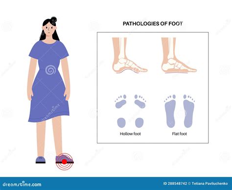 Foot Pathologies Poster Stock Vector Illustration Of Treatment 288548742