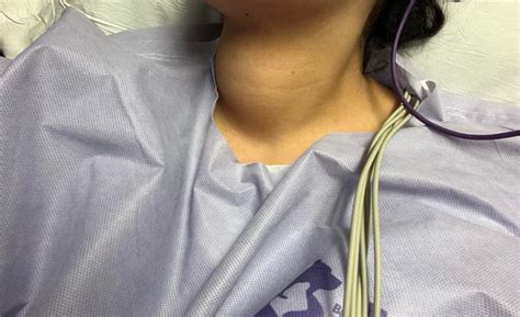 Thyroid Lobectomy Recovery And Heavy Schoolwork Rthyroidcancer