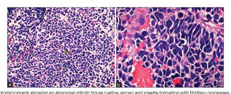 Figure 1 From A Rare Case Of Extraskeletal Ewings Sarcoma Primitive Neuroectodermal Tumor