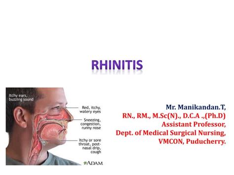 Rhinitis Pptx