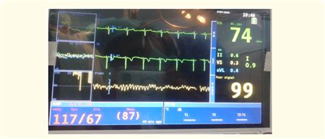 Intraoperative Hemodynamic Parameters Download Scientific Diagram