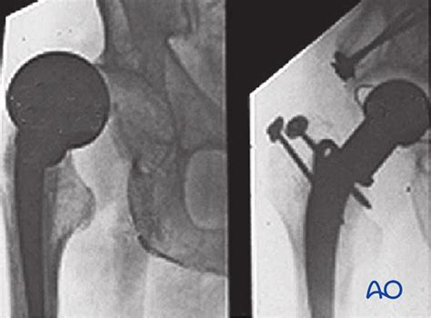 Total Hip Arthroplasty