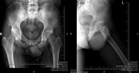 X Ray Of Pelvis And Left Hip Demonstrating Peri Articular Calcification Download Scientific