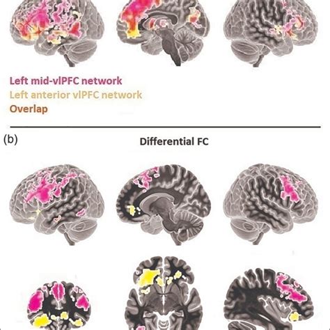 A Whole‐brain Functional Connectivity Fc For Left Mid‐ventrolateral