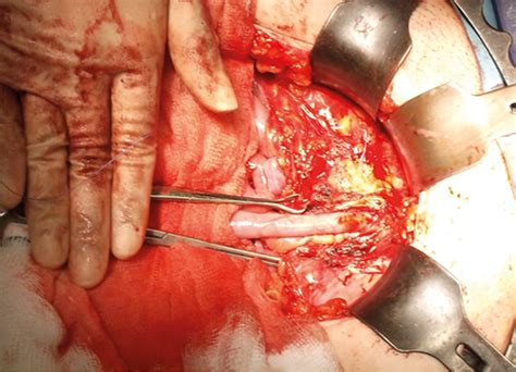 The Mitrofanoff Procedure A Continent Revolution Urology News