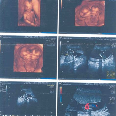 Pdf Dicephalic Parapagus Tribrachius Conjoined Twins In A Triplet Pregnancy A Case Report