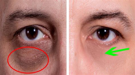 What Causes Lines And Bags Under Your Eyes At Jacqueline Sadler Blog
