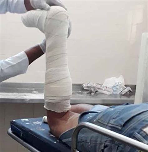 Homem Sofre Fratura Na Fíbula Em Acidente De Moto No Município De Mairi