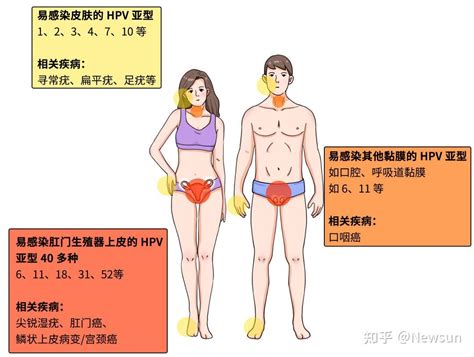 尖锐湿疣长在什么部位？ 知乎