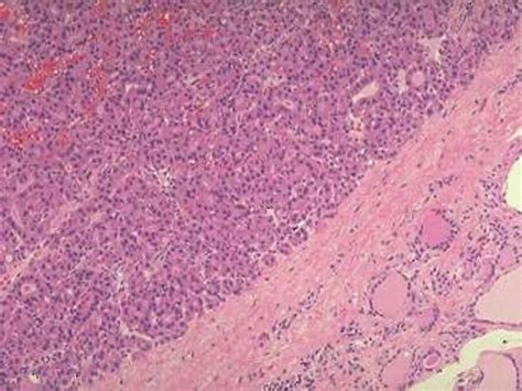 Thyroid Neoplasms Of Pathology Robbinspptx