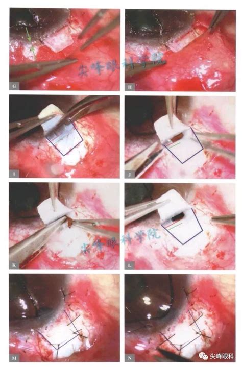 其他不同部位的小梁切除术 《图解青光眼手术操作与技巧》017 搜狐大视野 搜狐新闻