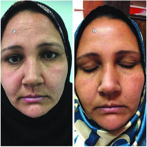 Glogaus Classification Of Photoaging 8 Download Scientific Diagram