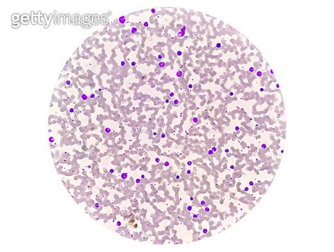 Chronic Myelogenous Leukemia CML Also Known As Chronic Myeloid Leukemia Is A Cancer Of The