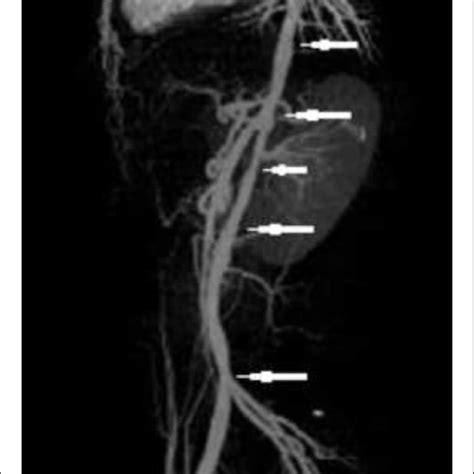 Computed Tomography Angiography Of The Thoracic And Abdominal Aorta