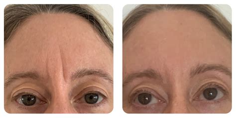 Minimizing Wrinkles Cosmologo