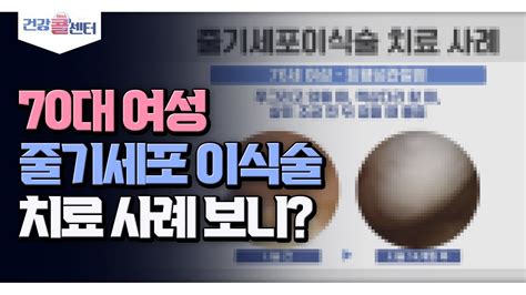 건강 콜센터 70대 여성 줄기세포 이식술 치료 사례 보니 Youtube