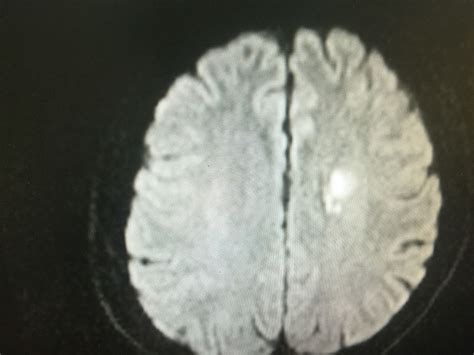 脉络膜前动脉梗塞！