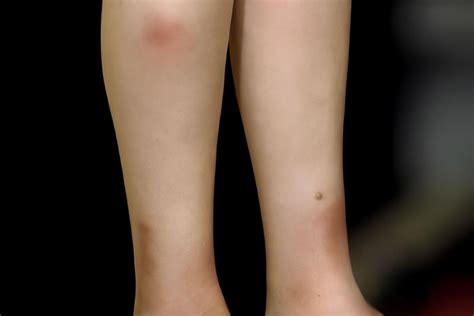 50 Facts About Erythema Nodosum