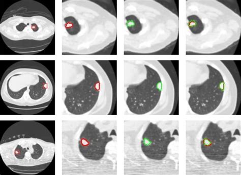 Examples Of Segmentation Results On The Lidc Dataset Using Gmmfcm Download Scientific Diagram