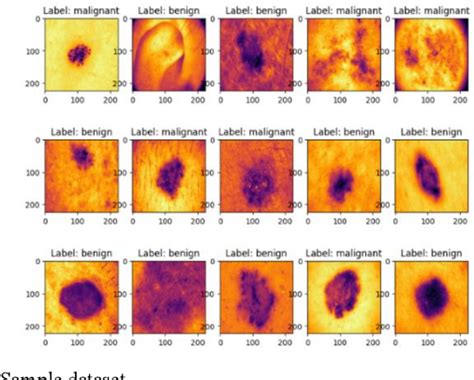 Figure 1 From Skin Cancer Classification Using EfficientNetV2 And ViT B16 Semantic Scholar