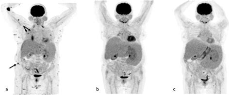 Position Emission Tomography Computed Tomography Images At Initial Download Scientific Diagram