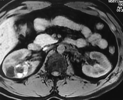 Vietnamese Medic Ultrasound Case 549 Renal Cystic Tumor Dr Phan