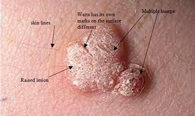 Genital And Common Warts Pictures On Different Body Parts