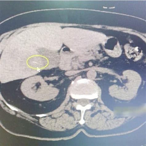 Contrast Enhanced Ct Scan Reveals An Elongated Hyperdense Structure