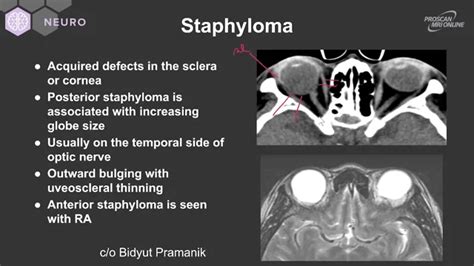 Coloboma Mri
