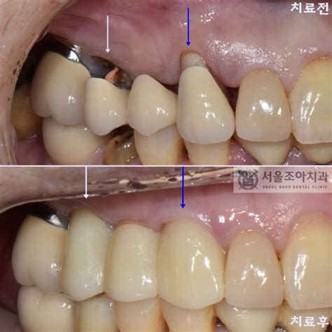 뿌리가 썪어버린 브릿지를 임플란트로 치료한 케이스 걸포동 임플란트 네이버 블로그