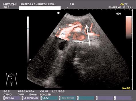 Power Doppler Usg Pancreatic Carcinoma Infiltrating Portal Vein