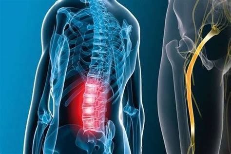 أعراض عرق النسا وعلاجه موقع معلومات