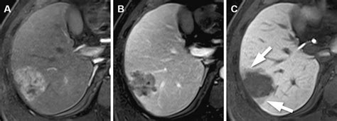 Hepatocellular Carcinoma With Peritumoral Hypointensity In The