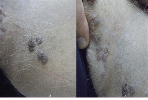 A B Multiple Small Well Defined Grey Brown Papules On The Scrotum Download Scientific